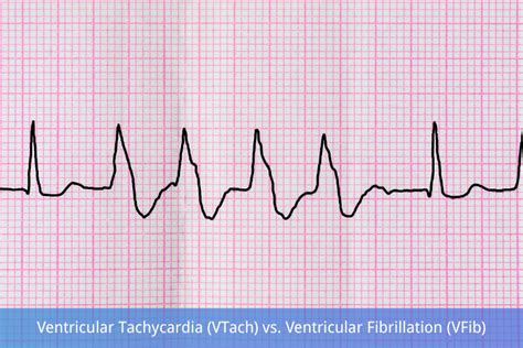 Ventricular Tachycardia Vtach Vs Ventricular Fibrillation Vfib