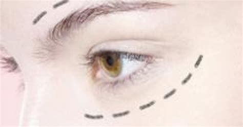 자가지방이식 줄기세포 이용하면 달라