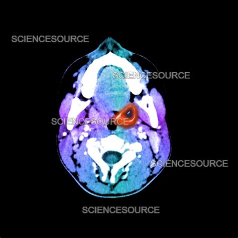 Color Enhanced Ct Of Tonsillar Abscess Stock Image Science Source
