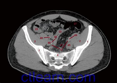 Ct Scan Abdomen Pelvis Anatomy Images And Photos Finder