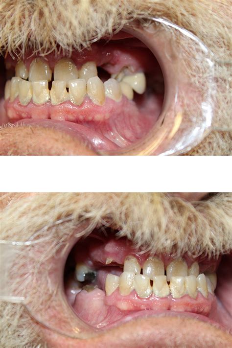 Tmj Treatments Gallery Before And After Patient 32 Tmj Expert