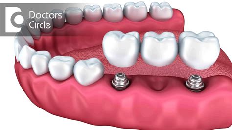What Is The Difference Between Dental Bridges And Dental Implants Dr