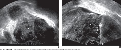 Figure 3 From Ultrasound Guided Transvaginal Core Biopsy Of Pelvic