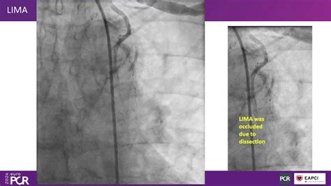 Complications In Stemi Sharing Is Key