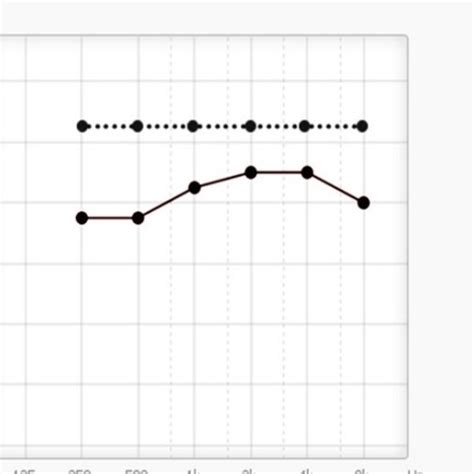 Mean Hearing Thresholds In The Affected And Contralateral Ears The