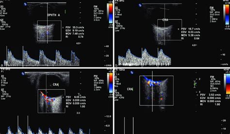 A Color Doppler Image Cdi Showing Normal Color Flow And Spectral