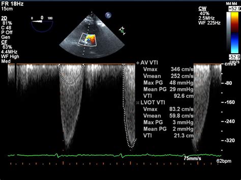 Stenosis Dimensionless Index Aortic Stenosis