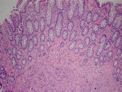 Pathology Outlines Leiomyoma