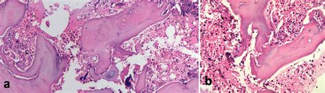 Histology Of Bone Marrow Trephine Biopsy A Bony Trabeculae Enclosing
