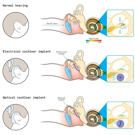 Restoring Hearing With Beams Of Light Ieee Spectrum