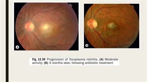 Infectious Uveitis Part 1 Pptx Ppt Upload Ppt