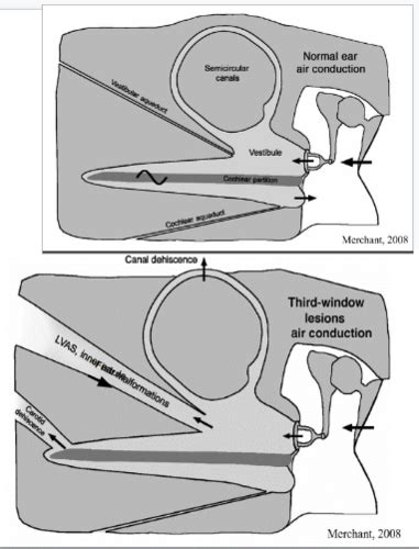 Week 4 Third Window Inner Ear Pathologies Flashcards Quizlet