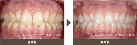 症例写真 ホワイトニング 肌と歯のクリニック 東京ベイ幕張 歯科 千葉