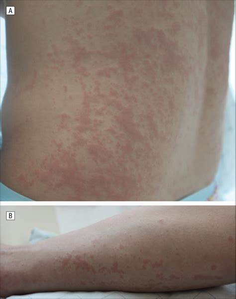 Clinical Findings In Patient 2 A Urticated Papules And Plaques On The Download Scientific
