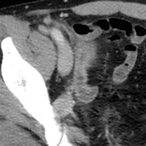 Abdomen And Retroperitoneum 1 5 Appendix Case 1 5 3 Complicated