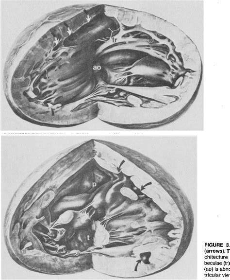 Figure 3 From Muscular Ventricular Septal Defects A Reappraisal Of The