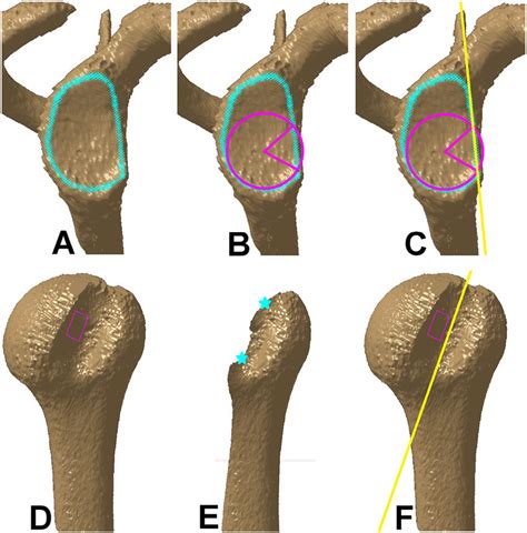 Identifying The Glenoid And Humeral Defect Axes A Selection Of Download Scientific Diagram