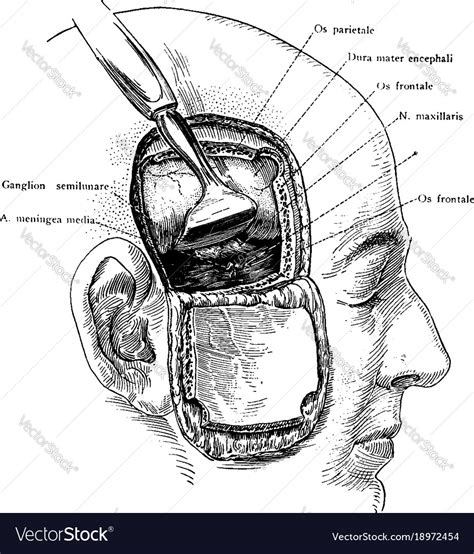 Incision Of The Head Showing Gasserian Ganglion Vector Image