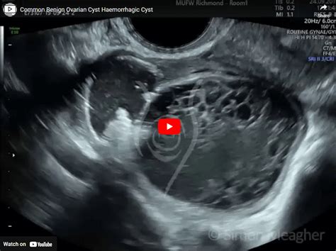 Common Benign Ovarian Cyst Haemorrhagic Cyst — International First