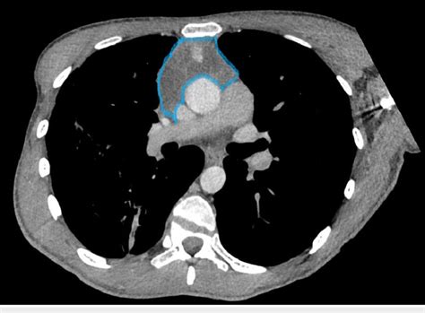 Complex Heterogeneous Anterior Mediastinal Mass Extended Into The