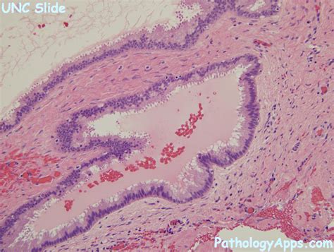 Tubal Metaplasia Cervix Histology