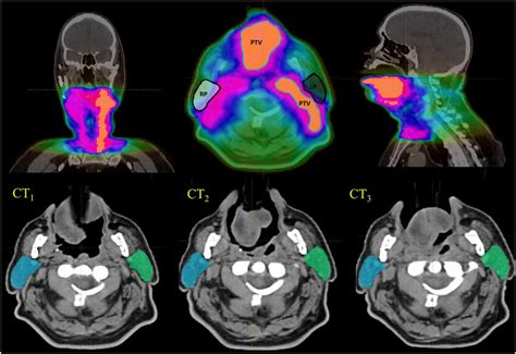 Upper Dosiomics Panel Dose Distribution Map Dose Image Was Used For