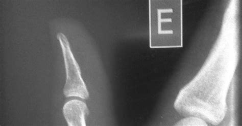 Dicas De Radiologia Imagens RadiolÓgicas Fratura Da Base Do Primeiro
