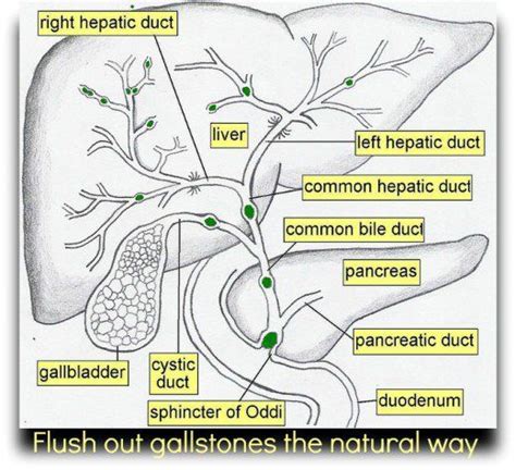 Gallbladder Disease Cholelithiasis Biliary Colic Cholecystitis Choledocholithiasis Cholangitis