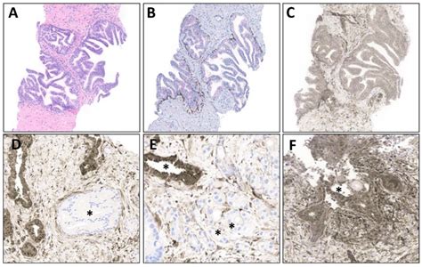 The Role Of Pten In The Differential Diagnosis Of Florid Hgpin And Download Scientific Diagram
