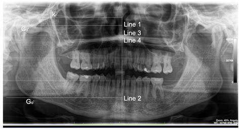 Coronoid Process Radiography