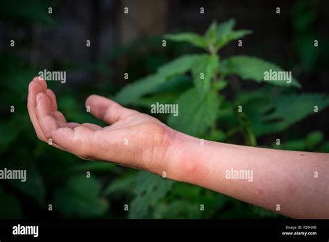 Stinging Nettle Rash American Idiot Gets His Ass Kicked By Stinging