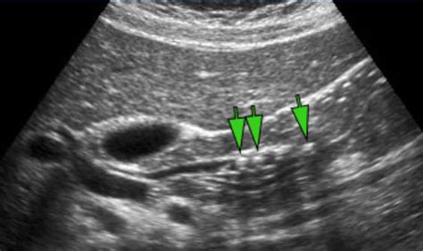 The Radiology Assistant Common Bile Duct Stones Ultrasound