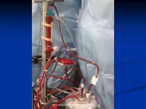 Ultrafiltration During Cardiopulmonarybypass Ppt