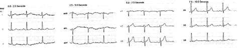 Dr Smith S ECG Blog May 2016
