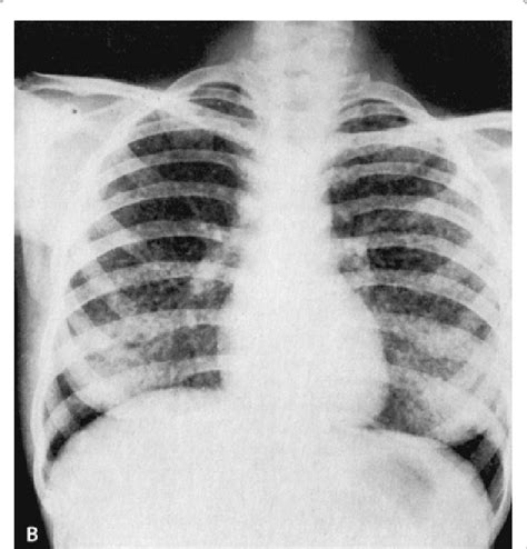 Chest X Ray Showing Bilateral Miliary Nodules 84 Download