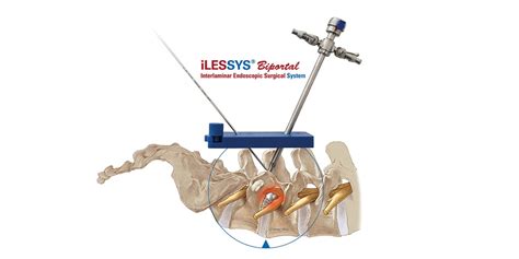 Joimax® Launches New Ilessys® Biportal Interlaminar Endoscopic Surgical