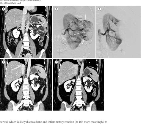 Figure 9 From Transarterial Embolization For Sporadic Renal