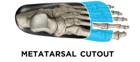 Correcting Diabetic Gait A Guide For Physicians Pt 2 Fdmotion