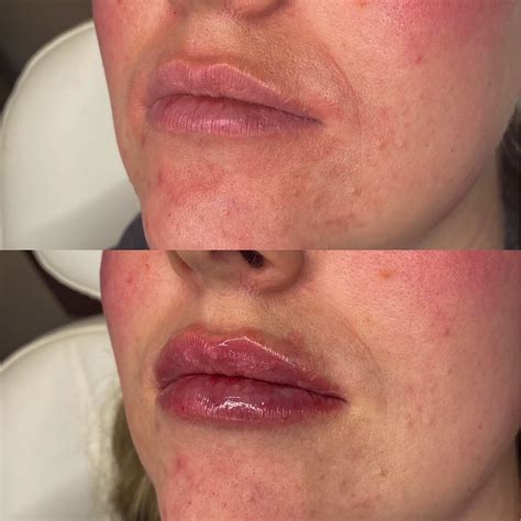 Dermal Fillers In Greenwood Village Co Fillers For Face