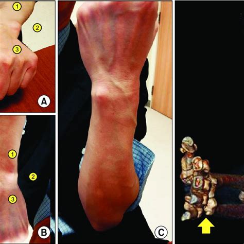 Pdf Where Is The Ulnar Styloid Process Identification Of The
