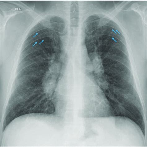 Small Round Opacities Of Type P Q 1 0 Profusion Download Scientific
