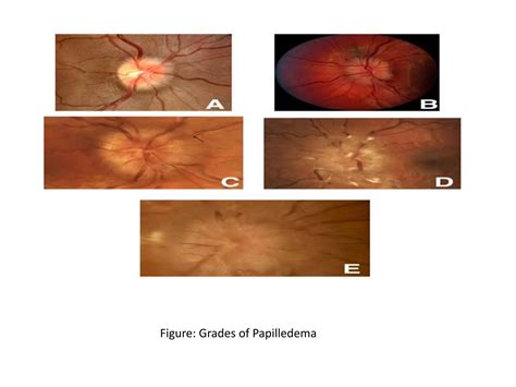 Lecture On Optic Neuritis And Papilledema For 4th Year Mbbs Undergraduate