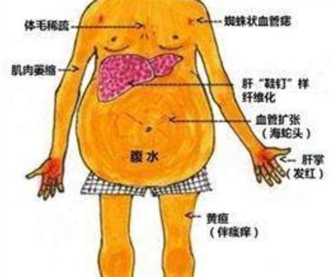 肝硬化腹水西医是怎么治疗及预防的？ 知乎