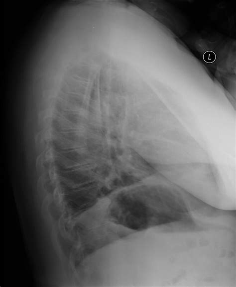 Radiopaedia Case Phrenic Nerve Palsy Secondary To Interscalene Brachial Plexus Block Id 98432