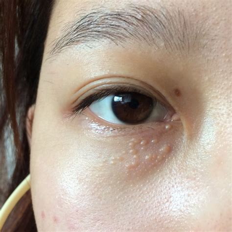 眼睛浮肿是不是跟肾脏有关系