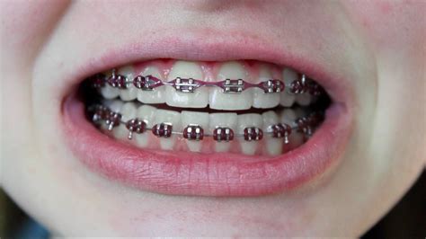 Wearing Braces With Rubber Bands