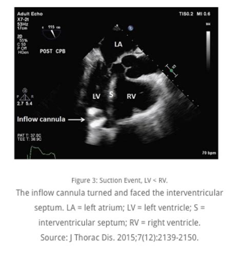 Left Ventricular Assist Device LVAD BROWN EMERGENCY MEDICINE