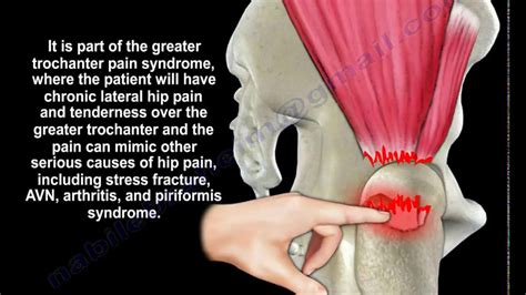 Gluteus Medius Pain