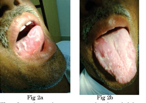 Figure 1 From Benign Migratory Glossitis An Unusual Enigmatic Lesion