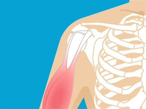 Ligament Vs Tendon Whats The Difference